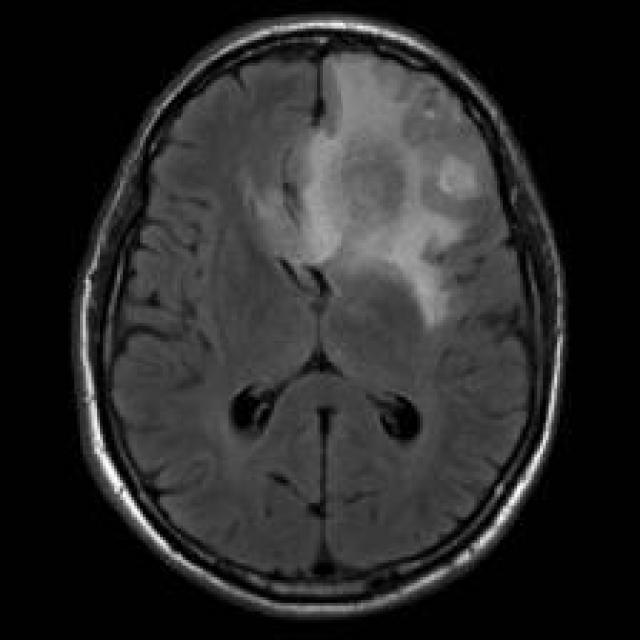Brain Tumor Detection Object Detection Dataset And Pre Trained Model By