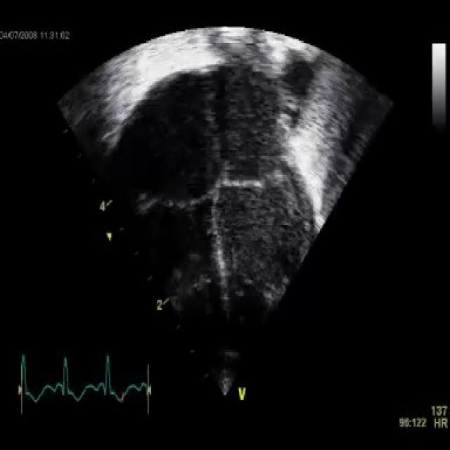 pediatric_echo Instance Segmentation Dataset by echo