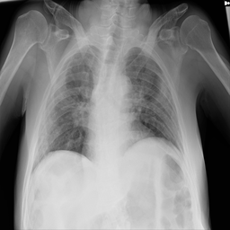 Pneumonia Detection Object Detection Dataset and Pre-Trained Model by ...