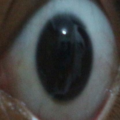 Cataract v01 Classification Dataset by Cataract