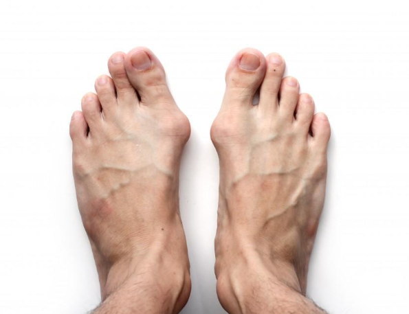 Hallux valgus discrimination Classification Dataset (v1, 2023-10-09 5 ...