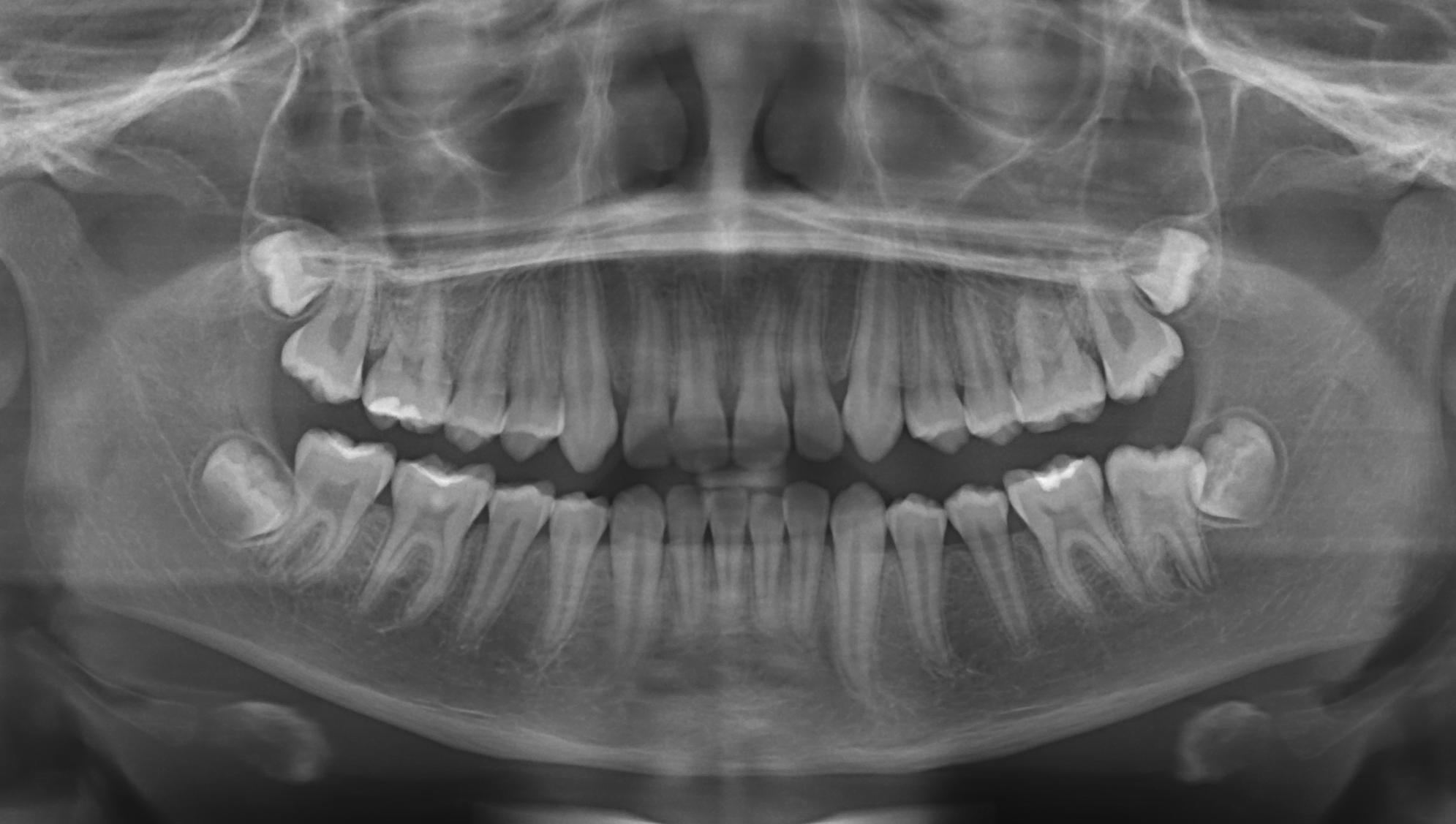 Teeth Classfication Instance Segmentation Dataset and Pre-Trained Model by Smriti