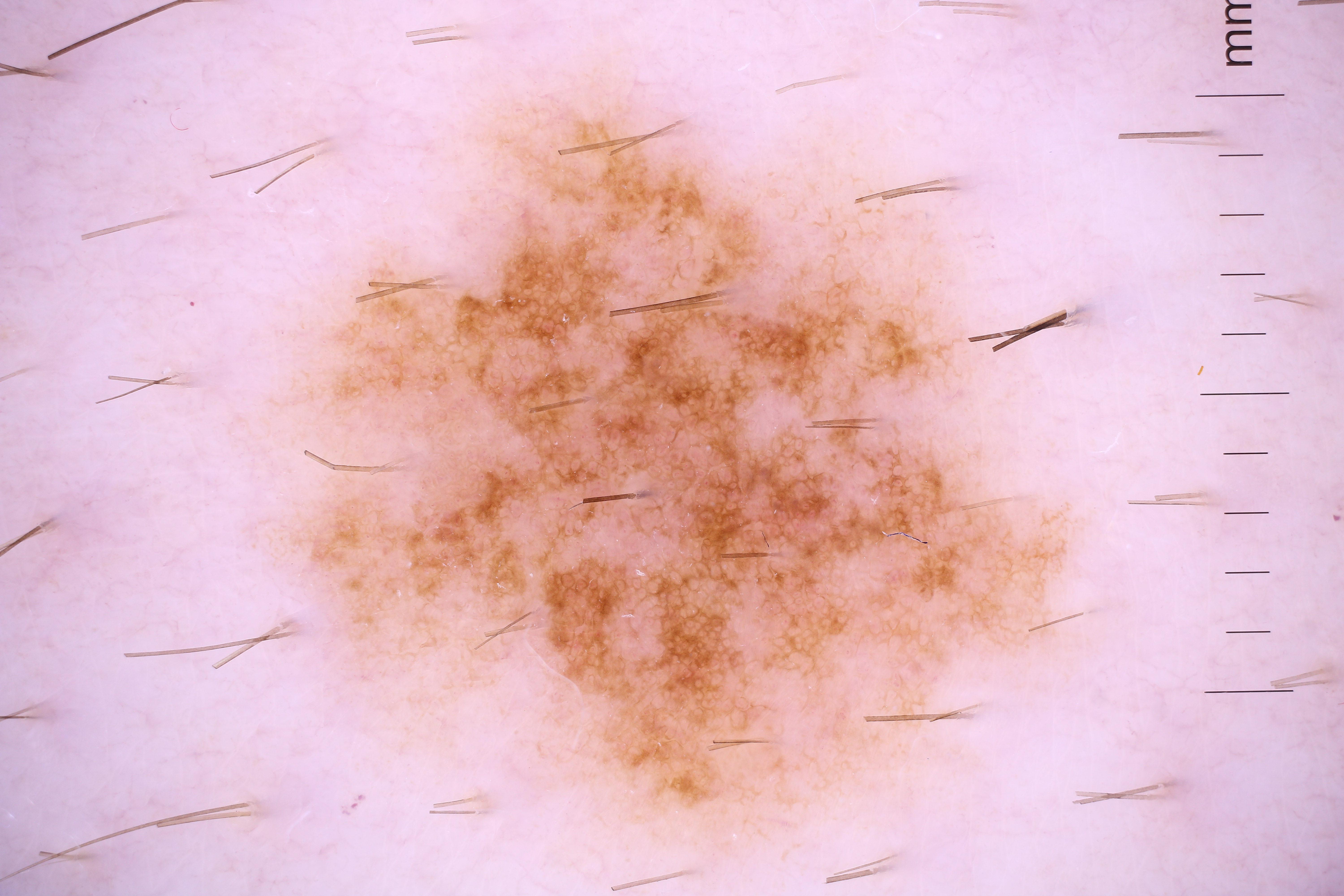 melanoma Object Detection Dataset and Pre-Trained Model by skripsi2