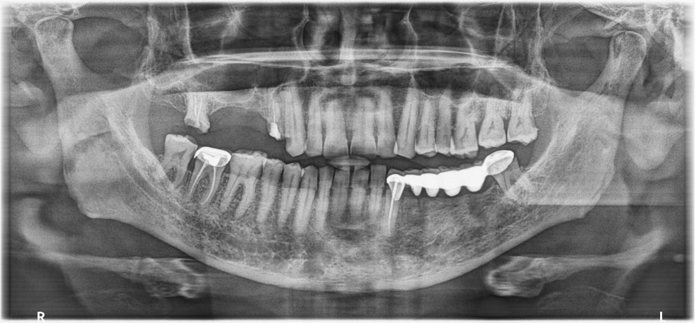 OPG images annotation Object Detection Dataset and Pre-Trained Model by ...