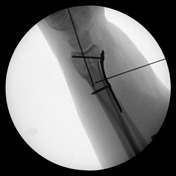 X ray bone fracture Object Detection Dataset and Pre-Trained Model by Unit
