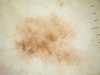 skin cancer detection Object Detection Dataset and Pre-Trained Model by ...