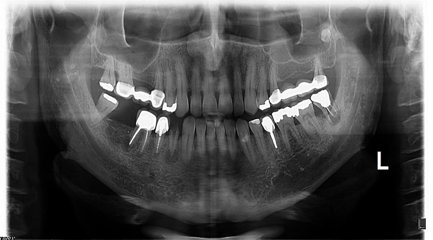 Tooth Instance Segmentation Object Detection Dataset And Pre Trained