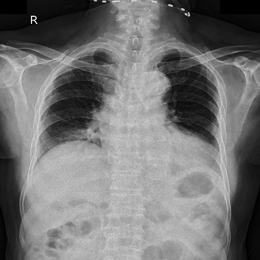 Original Chest Images Object Detection Dataset and Pre-Trained Model by ...