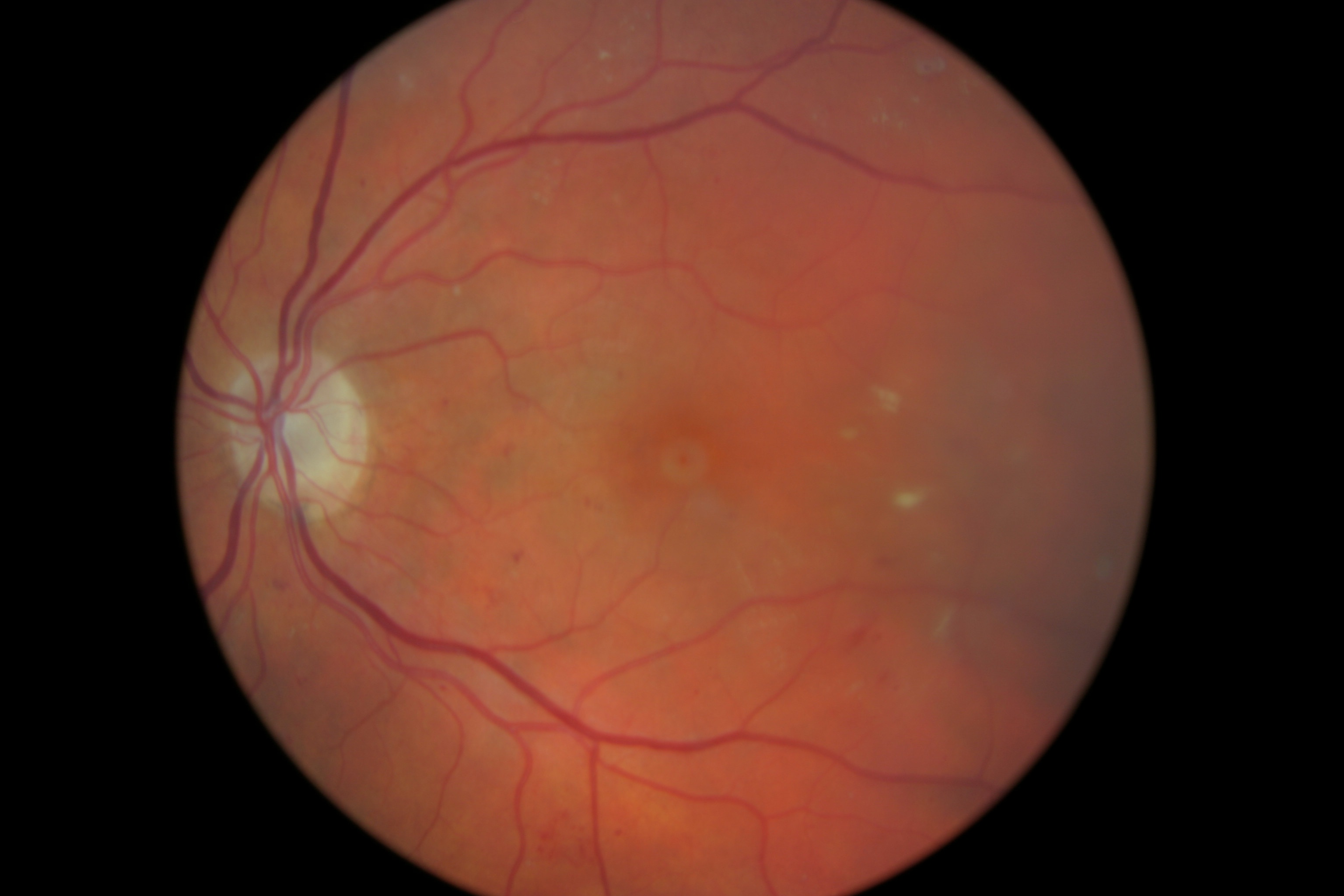 How To Use The Glaucoma Object Detection Api