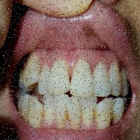 Teeth Shade Classification Instance Segmentation Dataset and Pre-Trained Model by Teeth shade ...