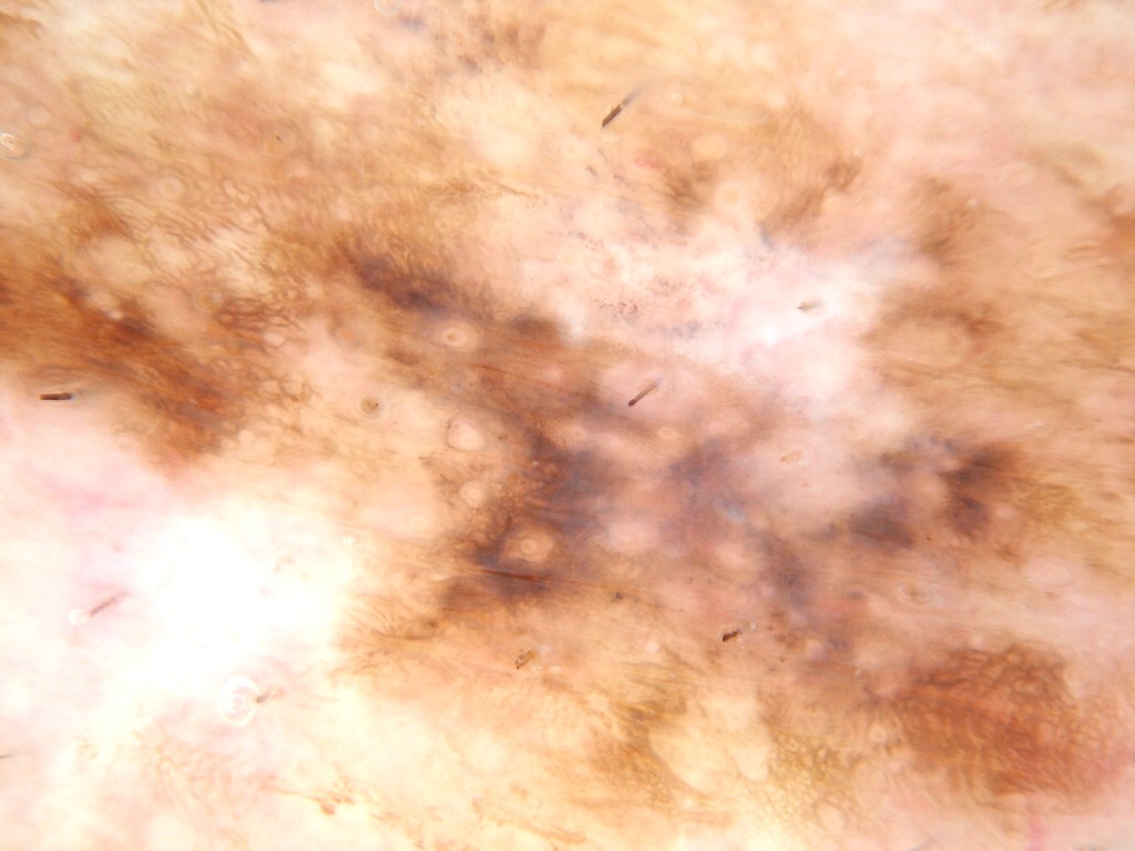 Skin Cancer Object Detection Dataset and Pre-Trained Model by Anuvind ...
