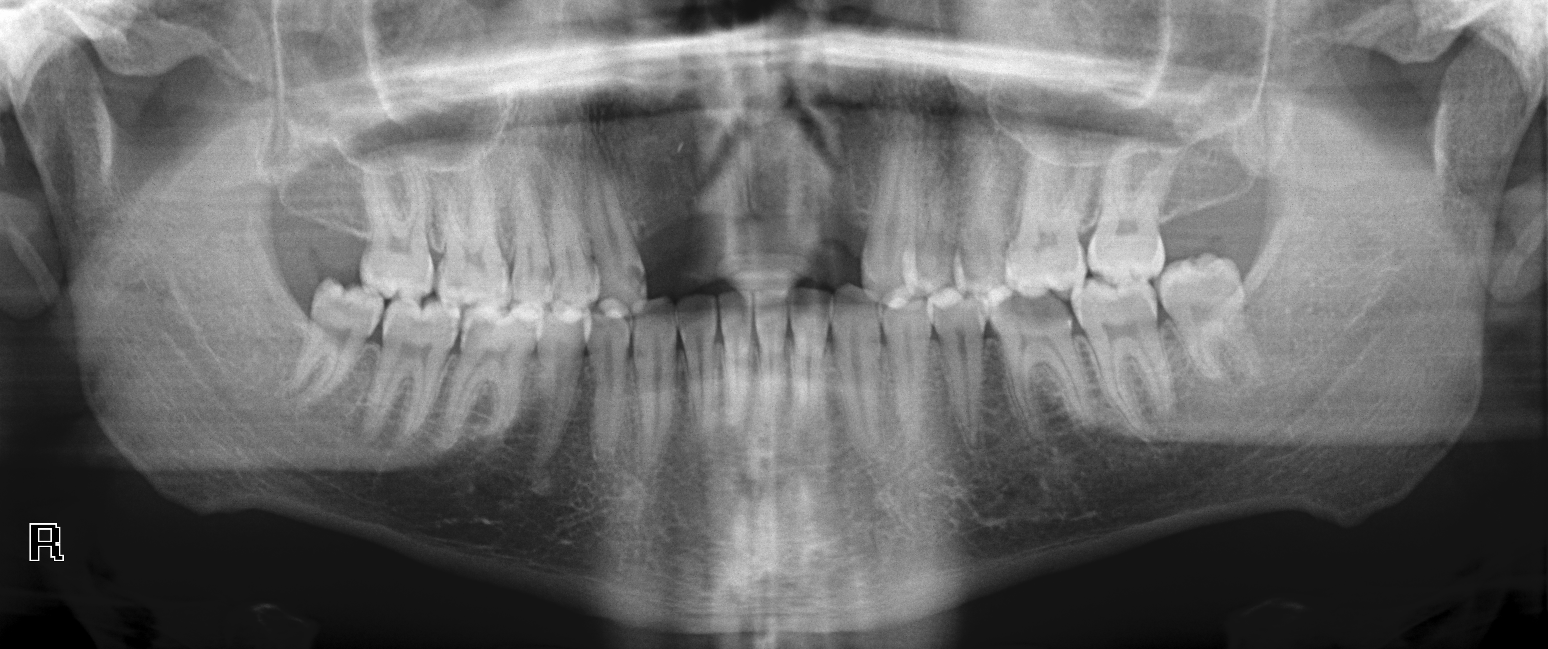 EMI-teeth Object Detection Dataset by EMI
