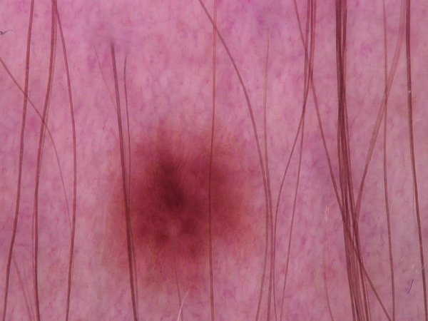 skin cancer classification Classification Dataset and Pre-Trained Model ...