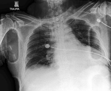 Diseases Classifier on CheXpert dataset Classification Dataset and Pre ...