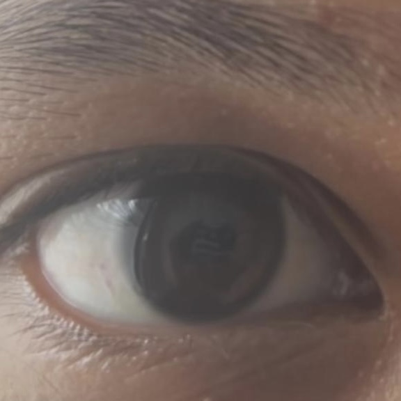 Cataract 3.0 Classification Dataset by Akmal Rusdy