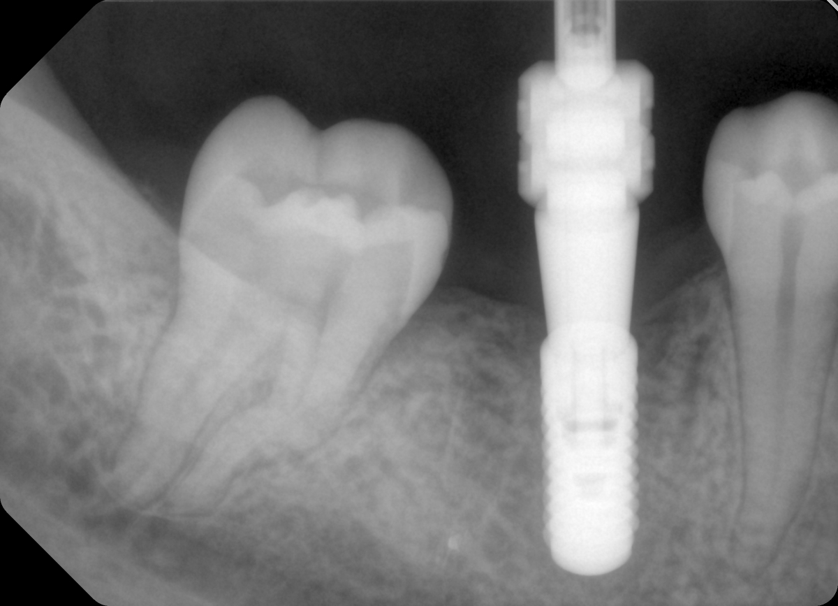 The dental implant brands recognition system Object Detection Dataset and Pre-Trained Model by ...