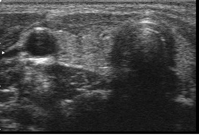 Hypothyroid classification Classification Dataset by Arunadevi ramesh