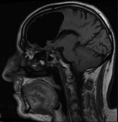 Brain Tumor Classification (MRI) Classification Dataset by CV