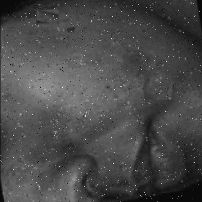 acne-detection-v1 Object Detection Dataset and Pre-Trained Model by Colab 1