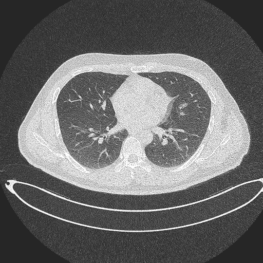 Detection of lung cancer Object Detection Dataset and Pre-Trained Model ...