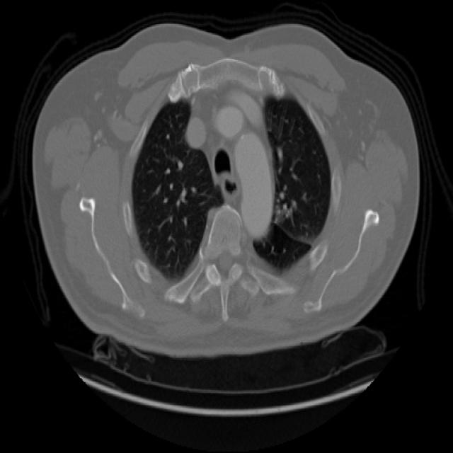 Lung cancer detect Classification Dataset by arunpatokar@gmail.com