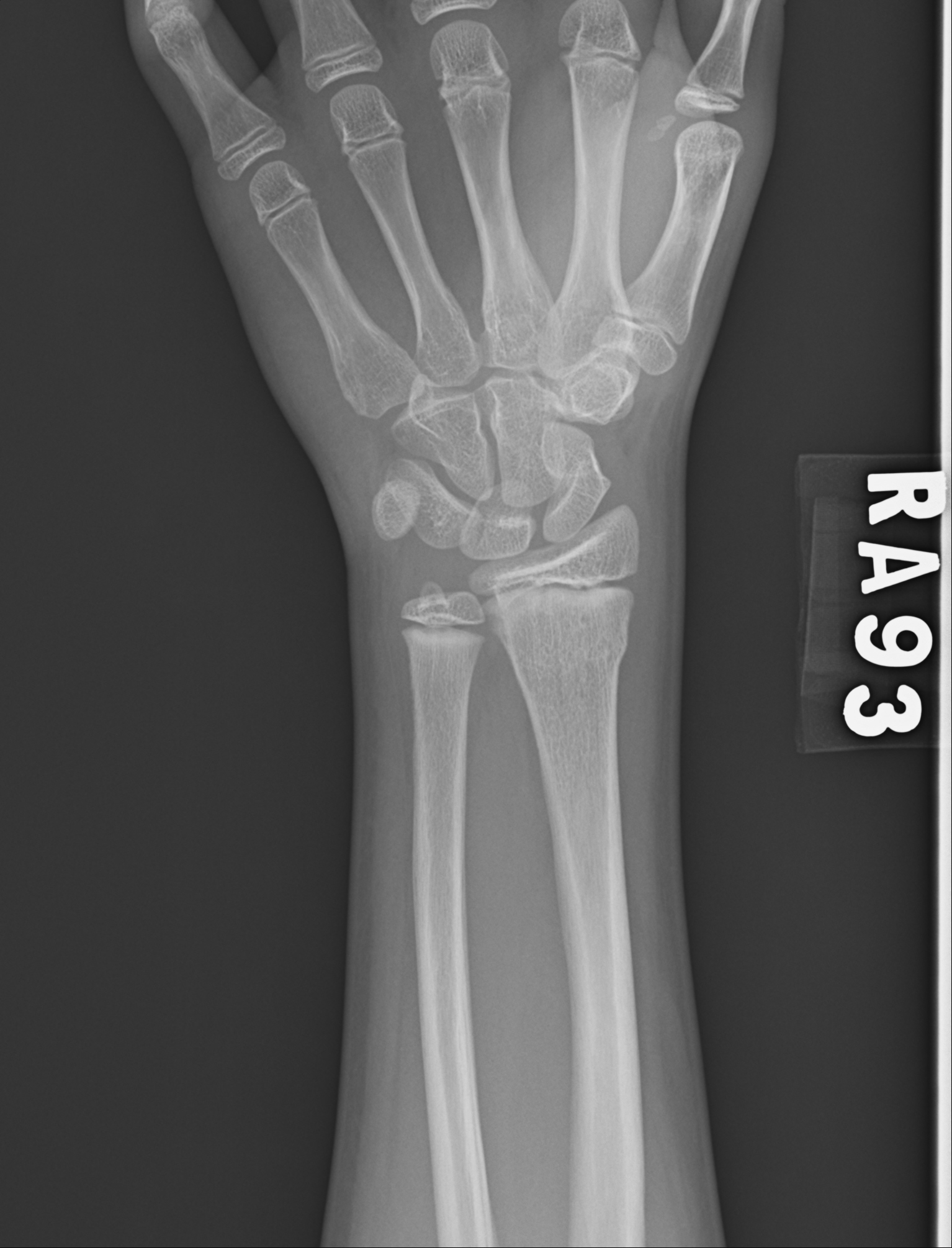 How To Use The Bone Fractures Object Detection Api