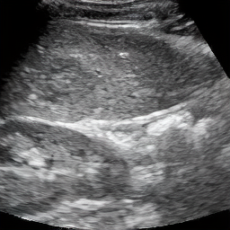 liver_ultrasound Object Detection Dataset and Pre-Trained Model by Joe Klepich