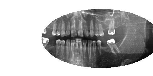 Tooth cavity detection Object Detection Dataset and Pre-Trained Model by Kaveri GC