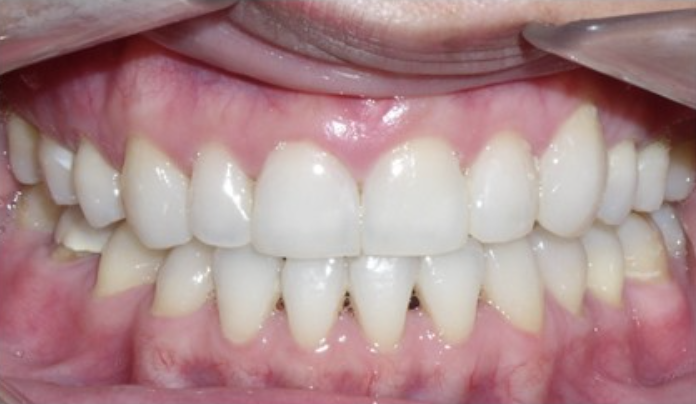 crooked detection Classification Dataset by Dental Mate