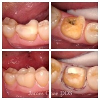 caries_detection Object Detection Dataset by Dental Mate