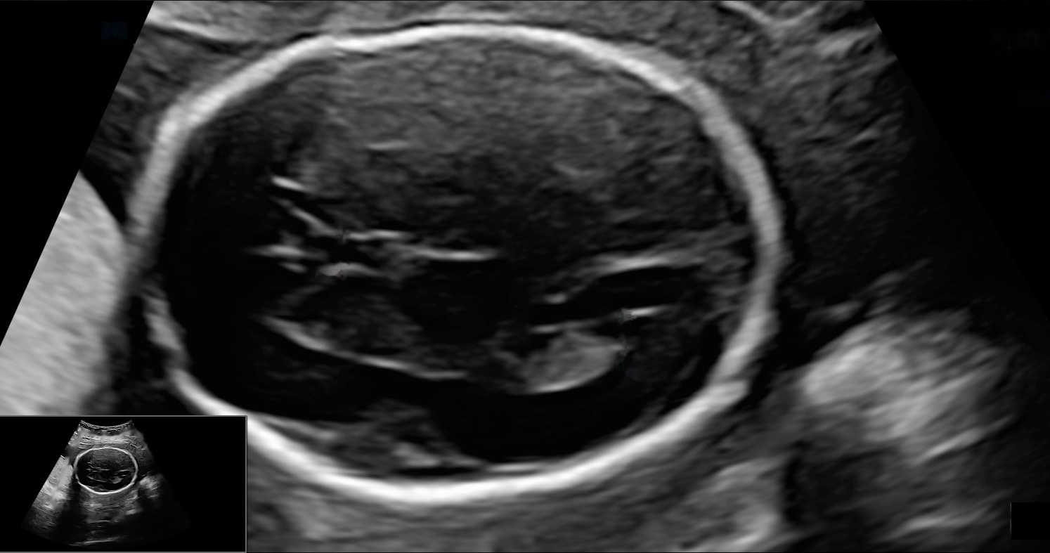 Transventricular Object Detection Dataset and Pre-Trained Model by Test