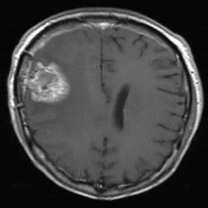 Brain Tumors Detection Object Detection Dataset and Pre-Trained Model ...