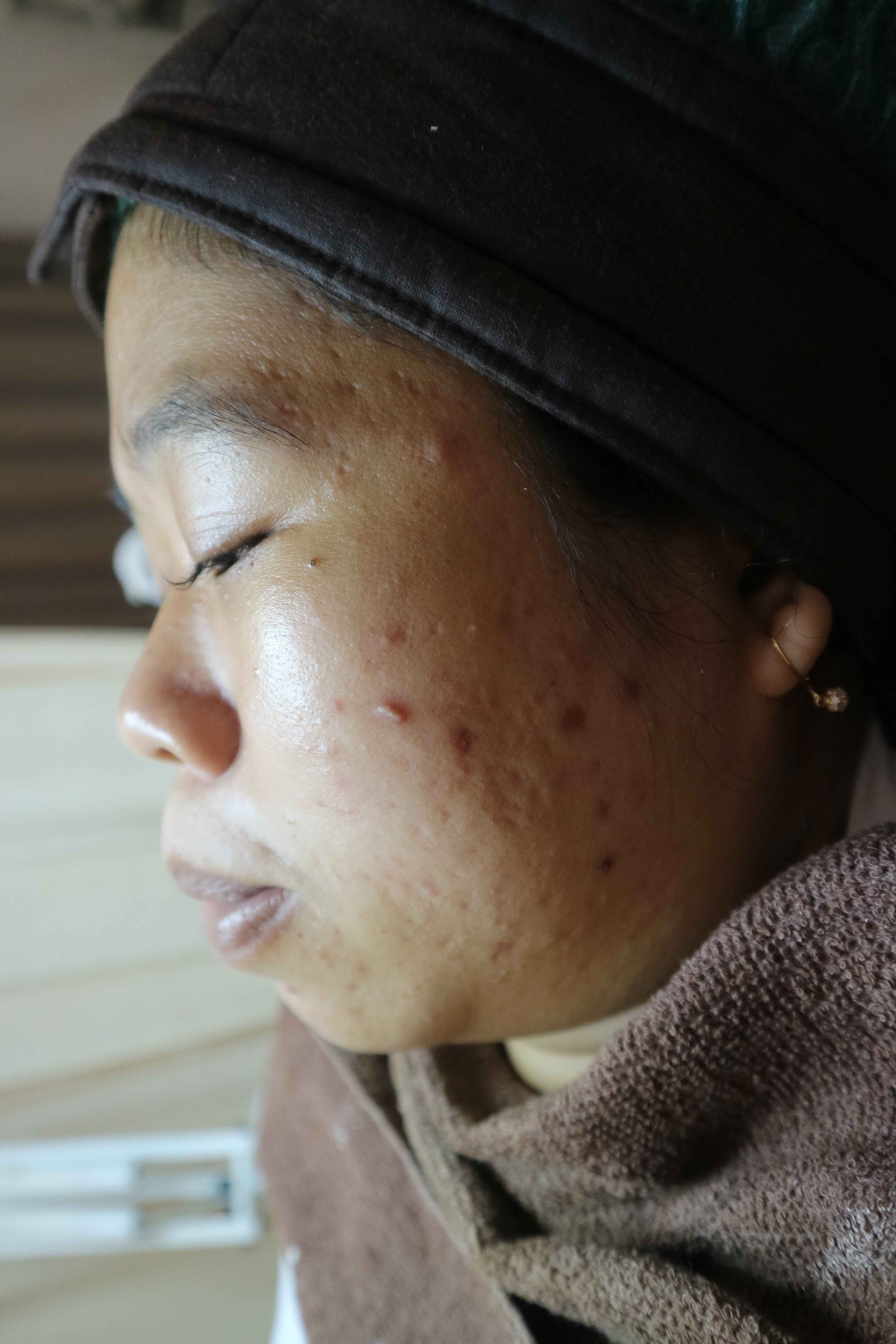 Clinic Data Object Detection Dataset By Acne Severity