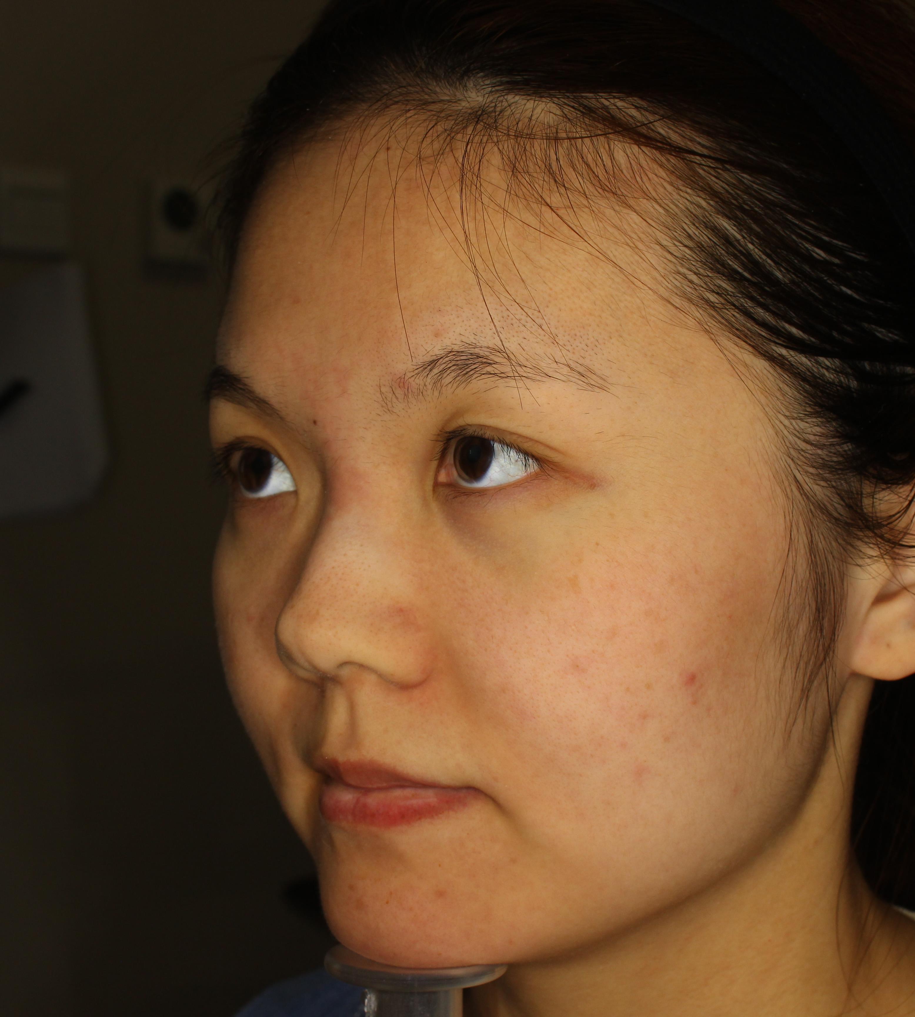 Test Object Detection Dataset By Acne Severity