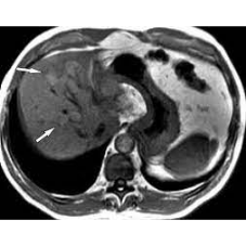 Liver Disease FYP Object Detection Dataset by Anna University