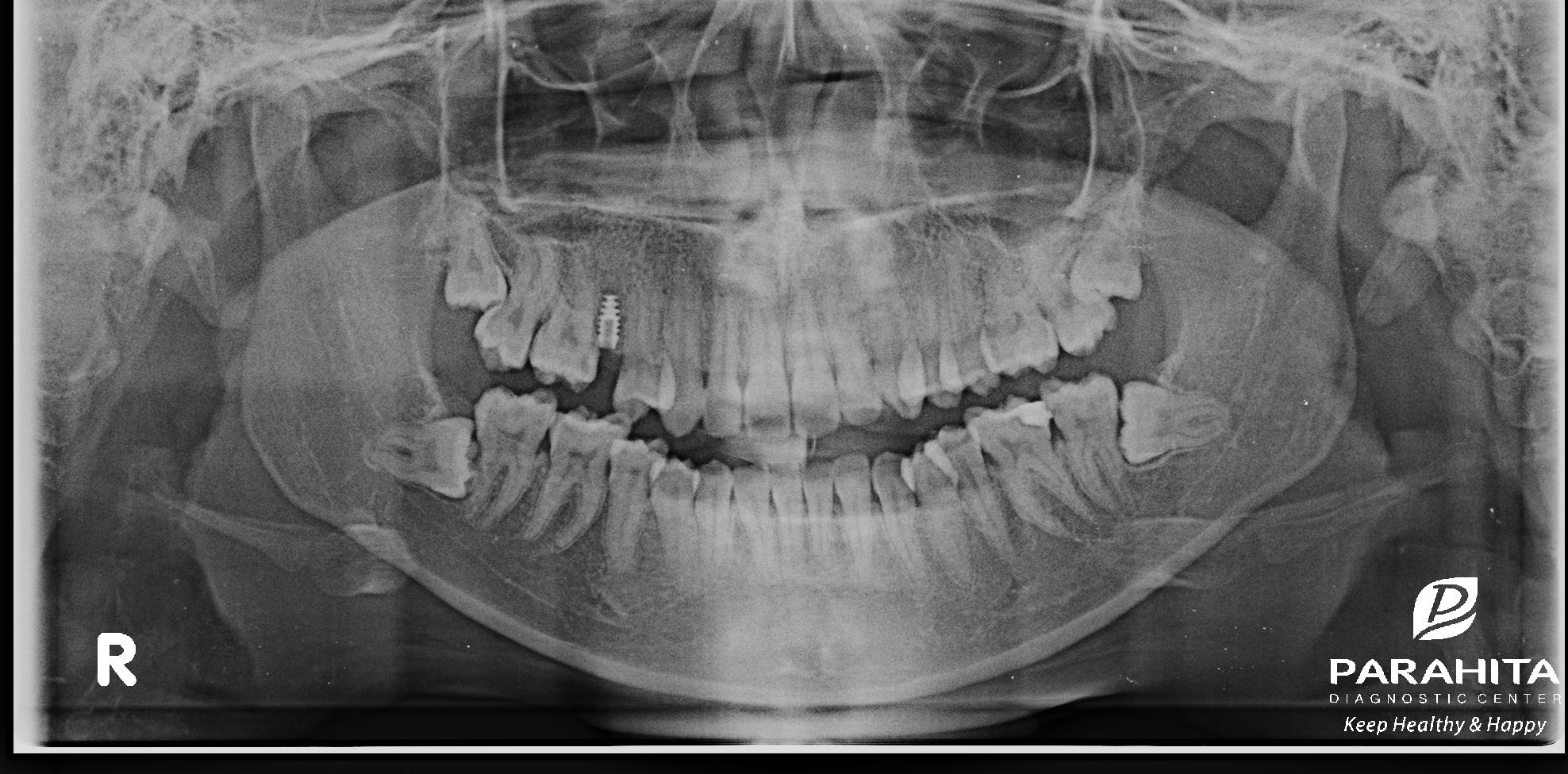 Tooth Detection Object Detection Dataset by Politeknik Elektronika Negeri Surabaya