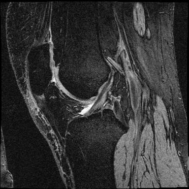 OAI-Sagittal Object Detection Dataset and Pre-Trained Model by OAI