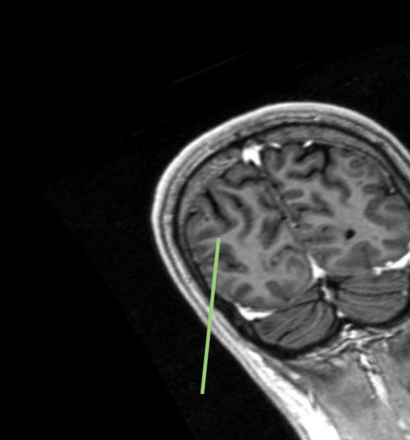 Coronal Scalpel MRI Instance Segmentation Dataset by Aniket Tadinada