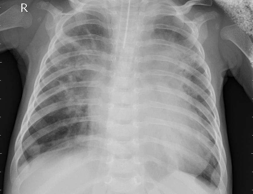 classification of pneumonia and normal patients Classification Dataset ...