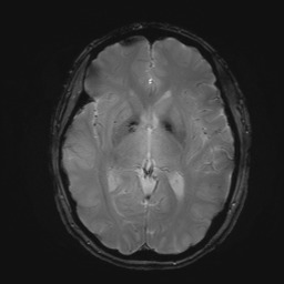detecting alzheimer in mri scans Classification Dataset and Pre-Trained ...