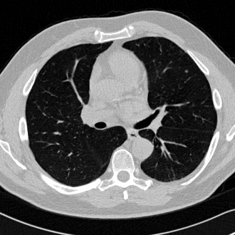 Luna16 Object Detection Dataset by AIden