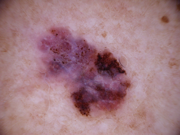 Skin cancer Instance Segmentation Dataset by Horizon School of digital technologies