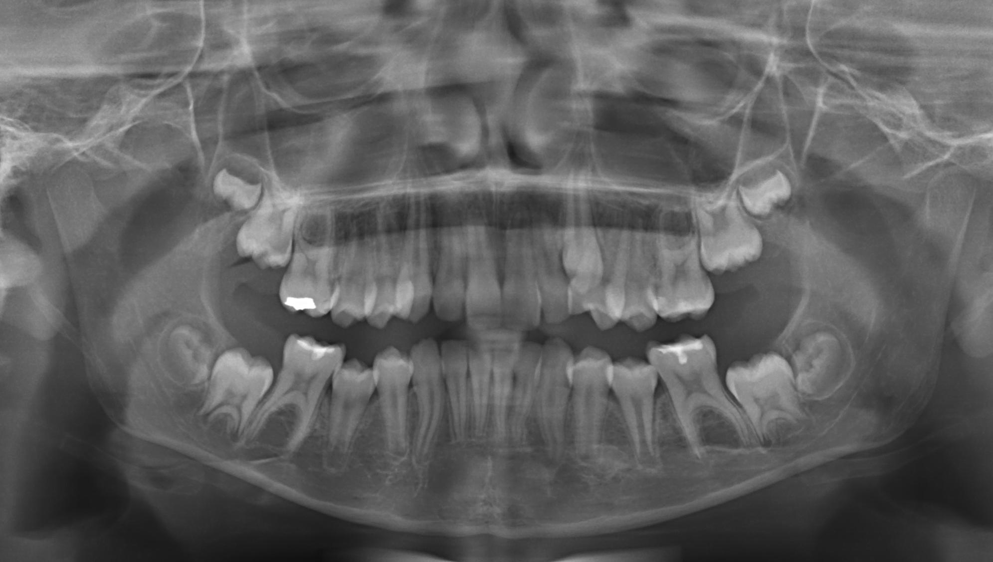 Teeth Object Detection Dataset by new-workspace-chs1l