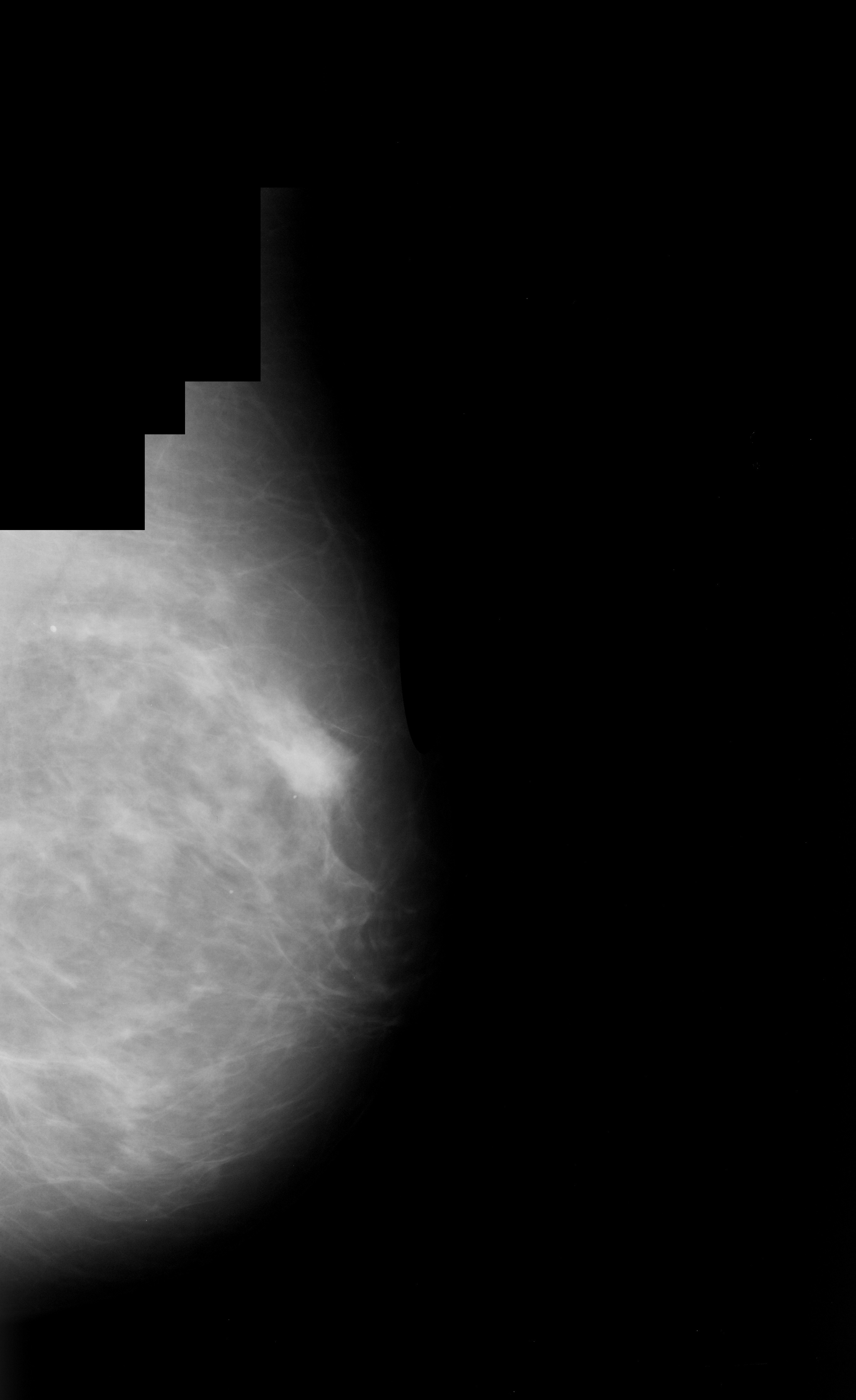 brest_cancer Object Detection Dataset by yolo5objectdetection