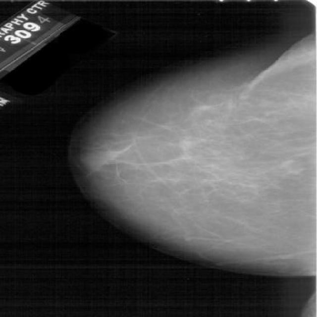 Breast Detection Object Detection Dataset By Yolo5objectdetection