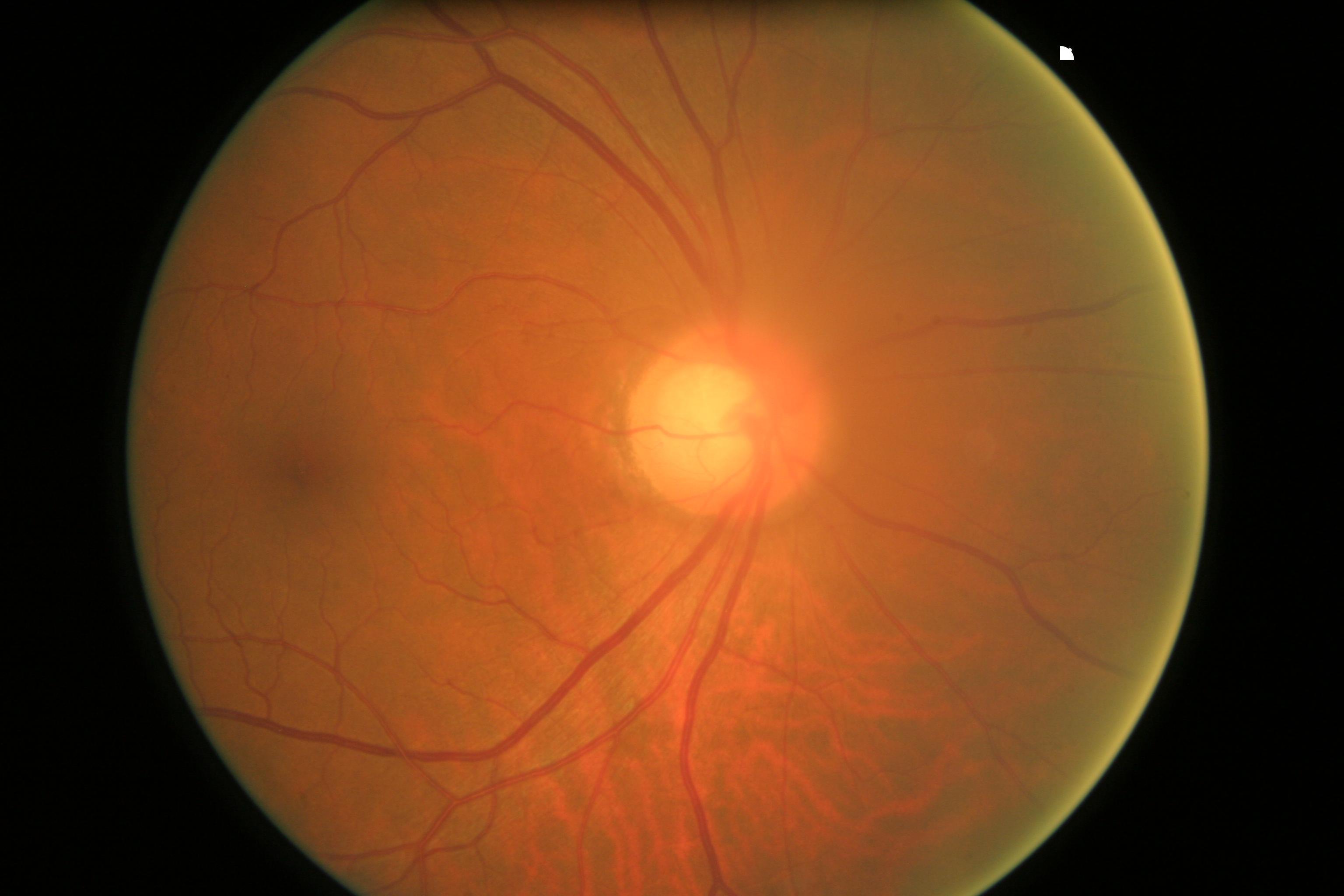 How to Use the optic disk detection Object Detection API