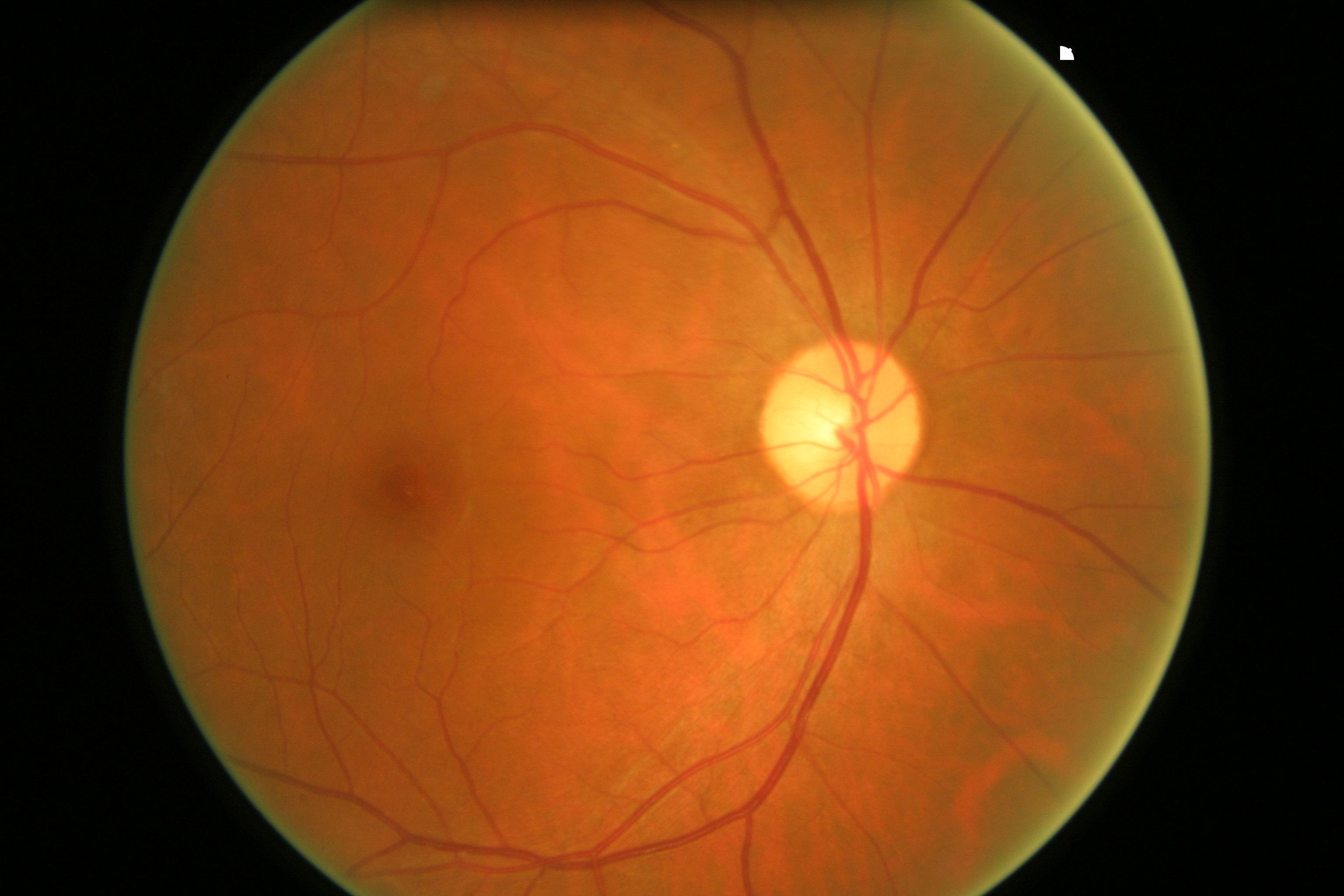 Glaucoma Prediction Classification Dataset And Pre Trained Model By Glaucoma