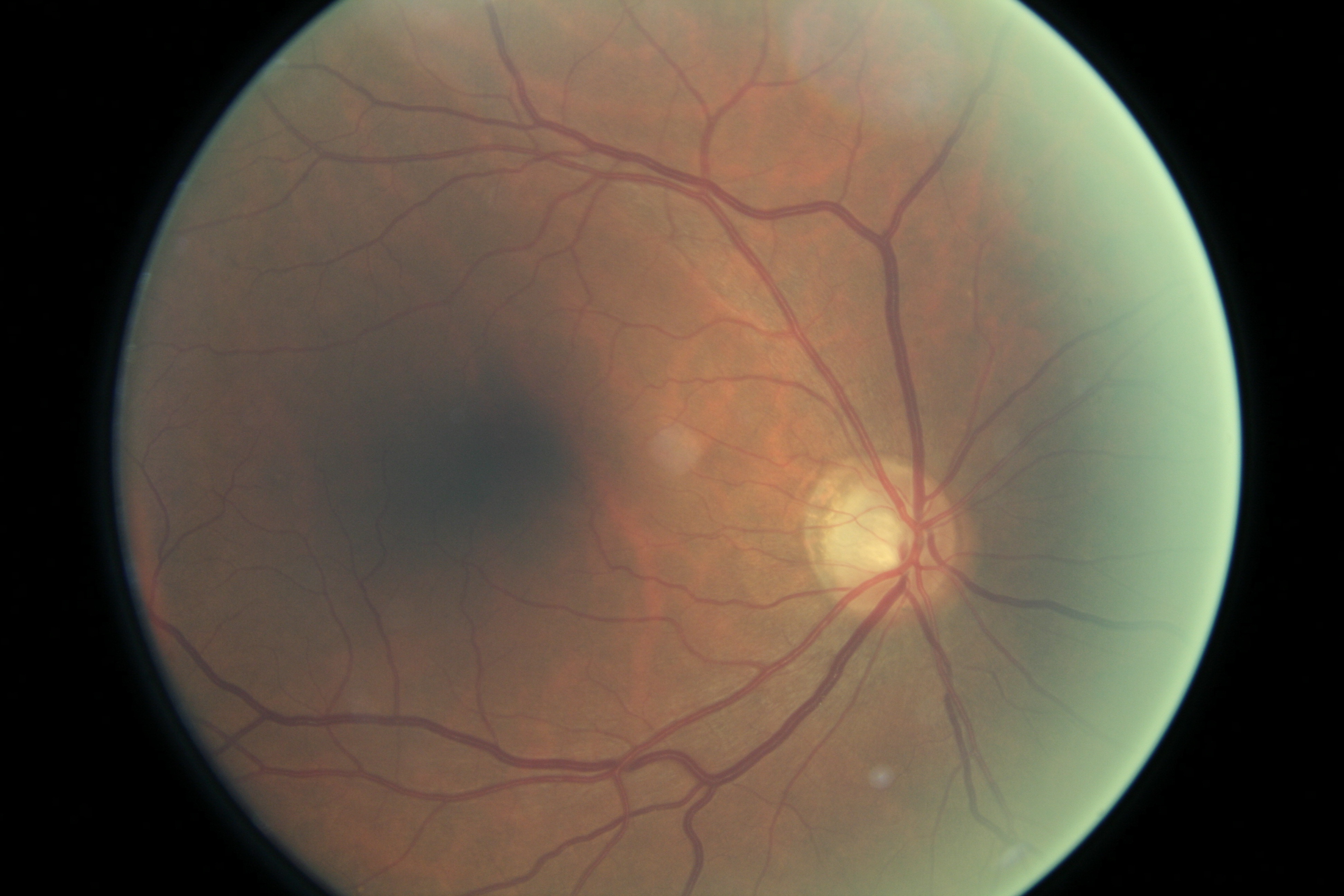 stages of Diabetic retinopathy Classification Dataset by research