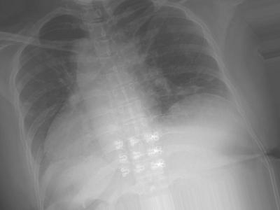 Lung Disease Detection Object Detection Dataset and Pre-Trained Model by AI