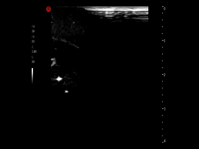 How to Use the fistula detection Classification API